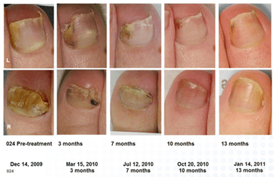 LASER - MYCOSE DES ONGLES